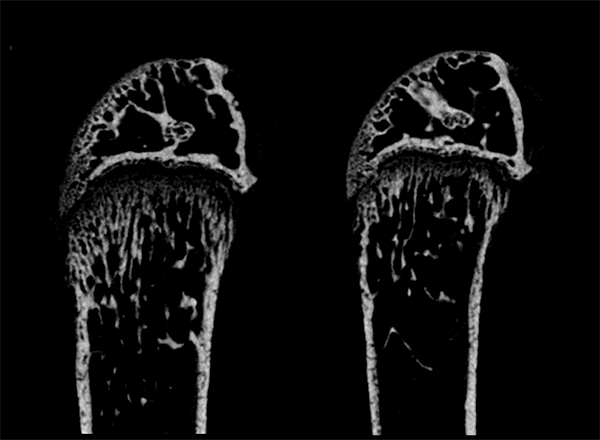 Reversing severe bone loss